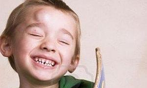 Comiezan los chichones | Ideal